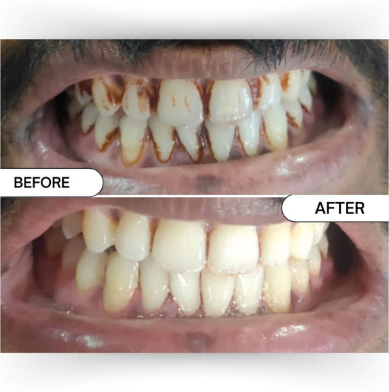 Fang Teeth Whitening V1 – Fang Oral Care